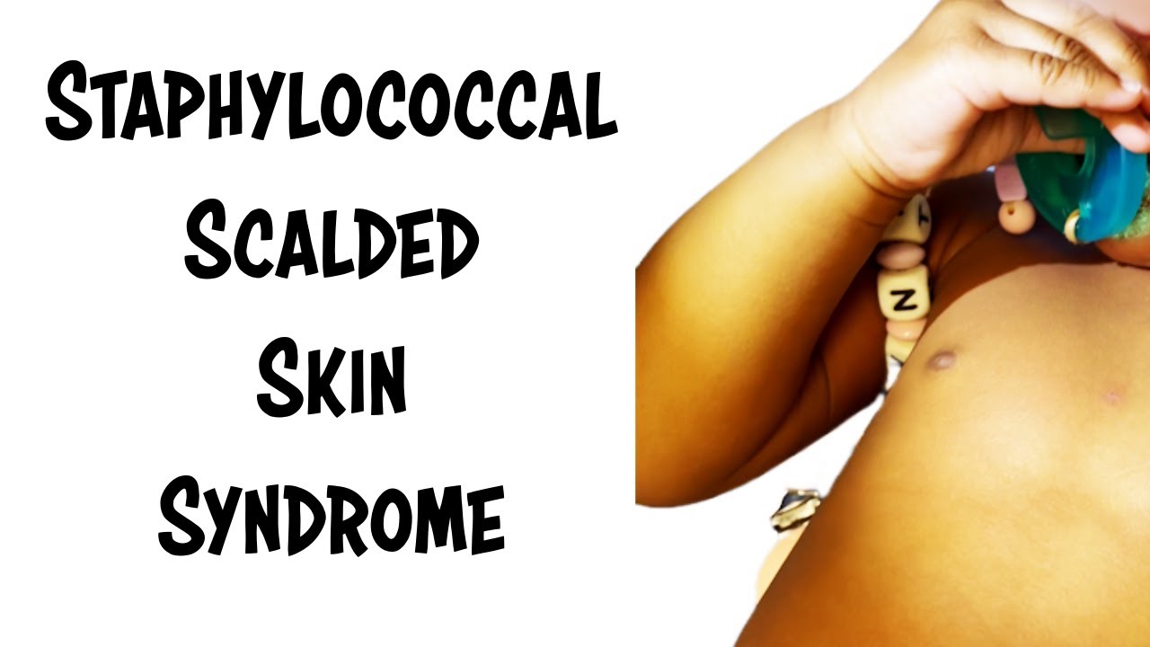 Staphylococcal Scalded Skin Syndrome - YouTube