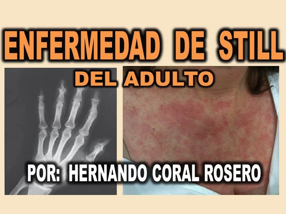 ENFERMEDAD DE STILL DEL ADULTO - ARTRITIS Y ERUPCIONES CUTANEAS - YouTube