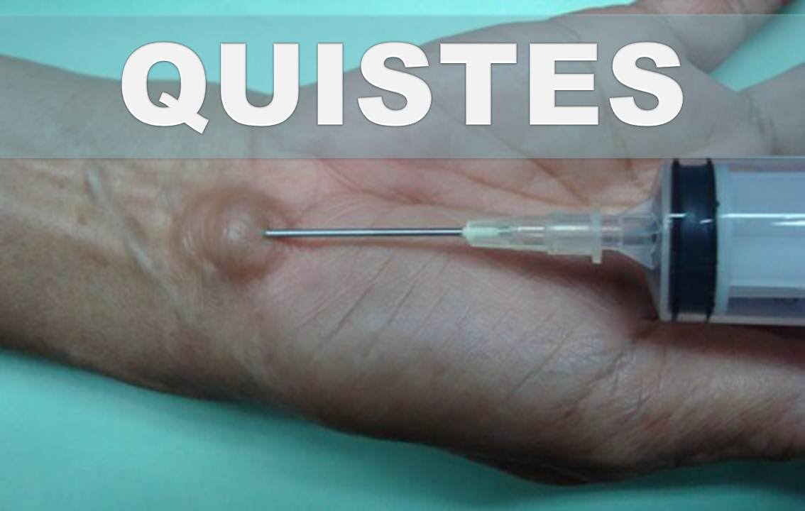 Ingredientes caseros para quistes ganglionar - Como reducir los quistes ...