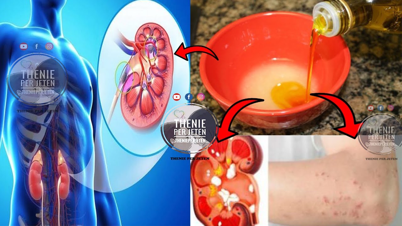 Kapini sa jeni ne kohe: Ja shenjat qe tregojne se keni gure ne veshka ...