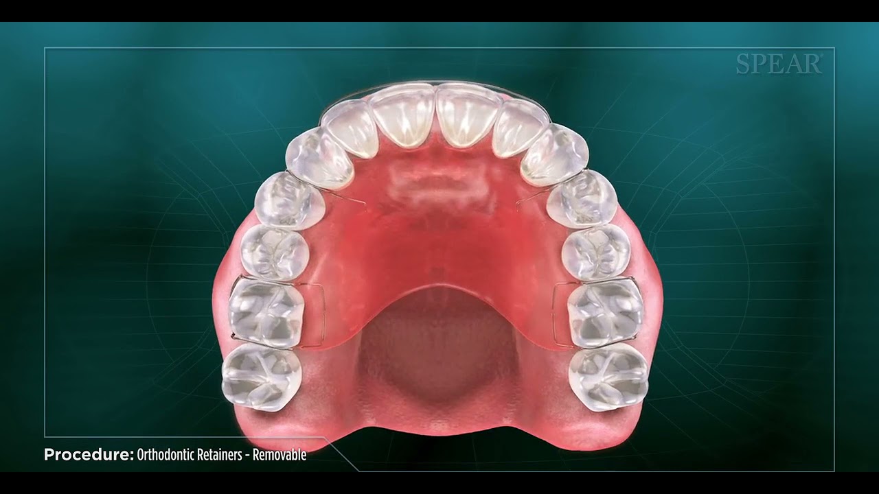 Orthodontic Retainers – Removable - YouTube