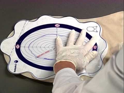 Coloplast® Fístula - YouTube