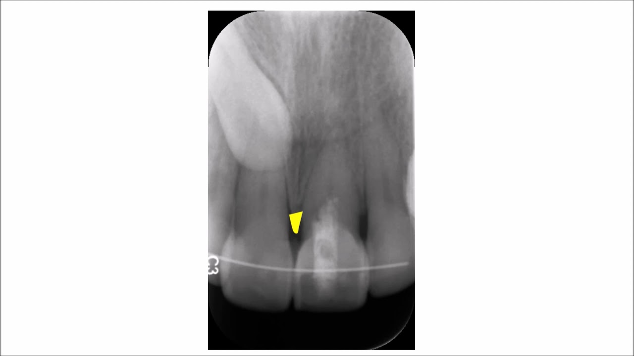 Normal Appearance of the Alveolar Bone Crest Anterior Teeth - YouTube