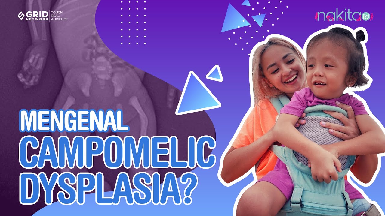 Dialami Anak Joanna Alexandra, Apa Itu Campomelic Dysplasia? - YouTube