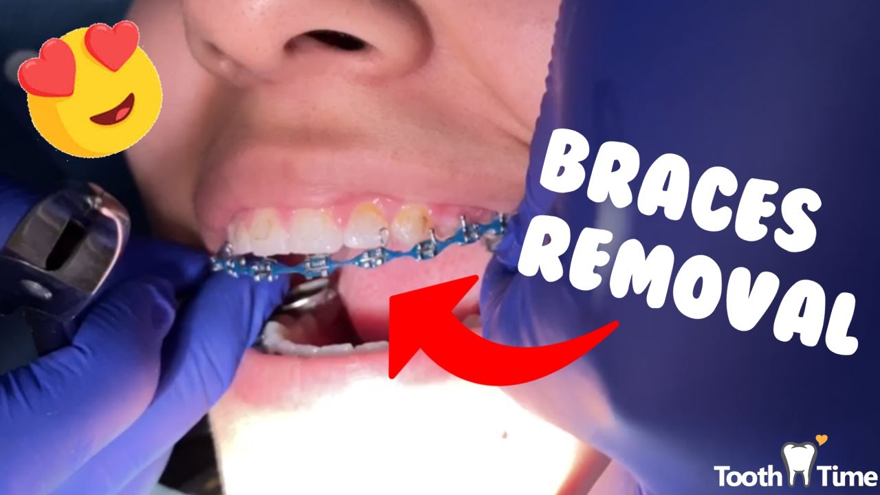 Braces off - I'm so happy I love my smile - Tooth Time Family Dentistry ...
