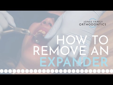 Expander Removal Process | Jones Family Orthodontics | Monroe, WA - YouTube