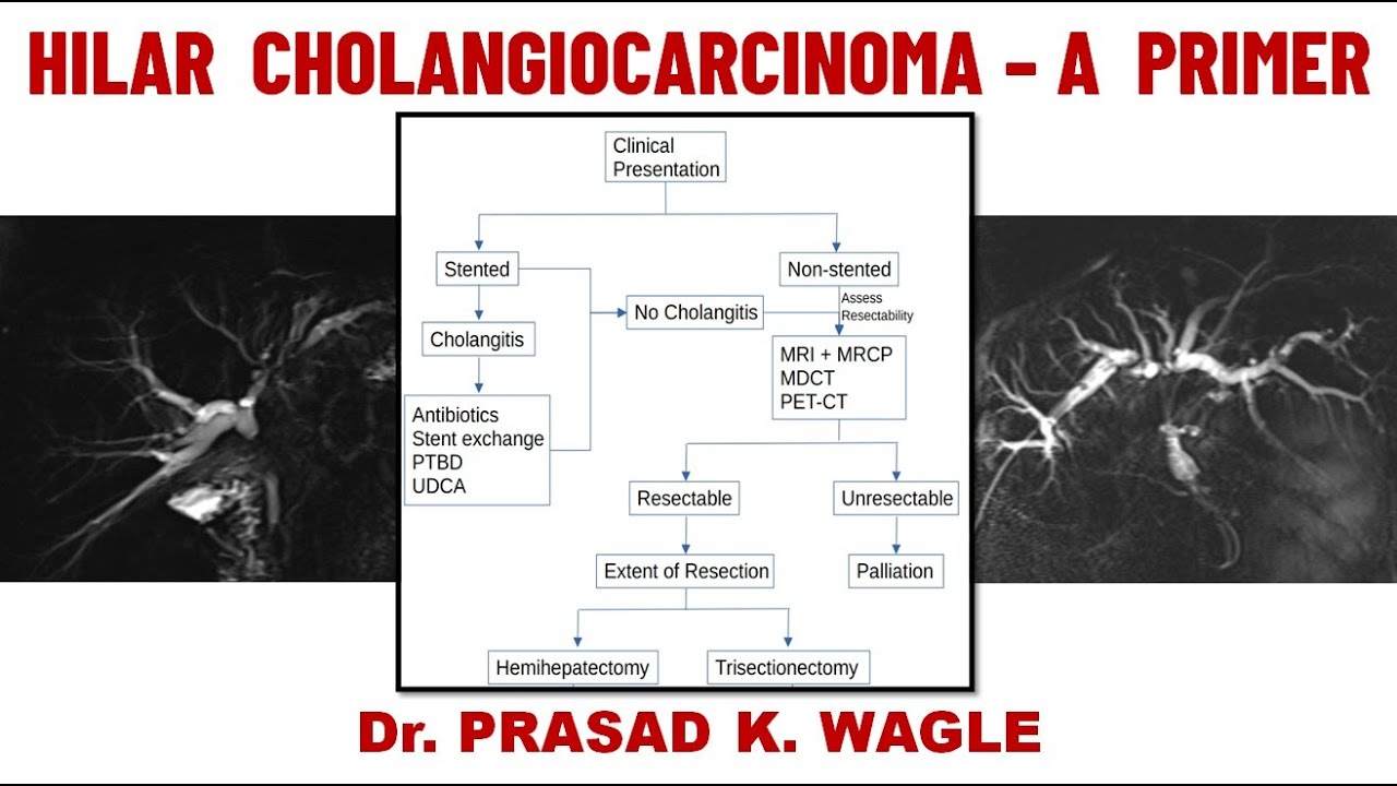 Management of hilar cholangiocarcinoma - Addressing key issues in ...