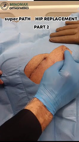 SuperPATH Hip Replacement : Part 2 - YouTube