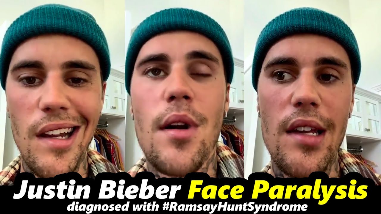 Justin Bieber Suffers From Ramsay Hunt Syndrome | Justin bieber face ...