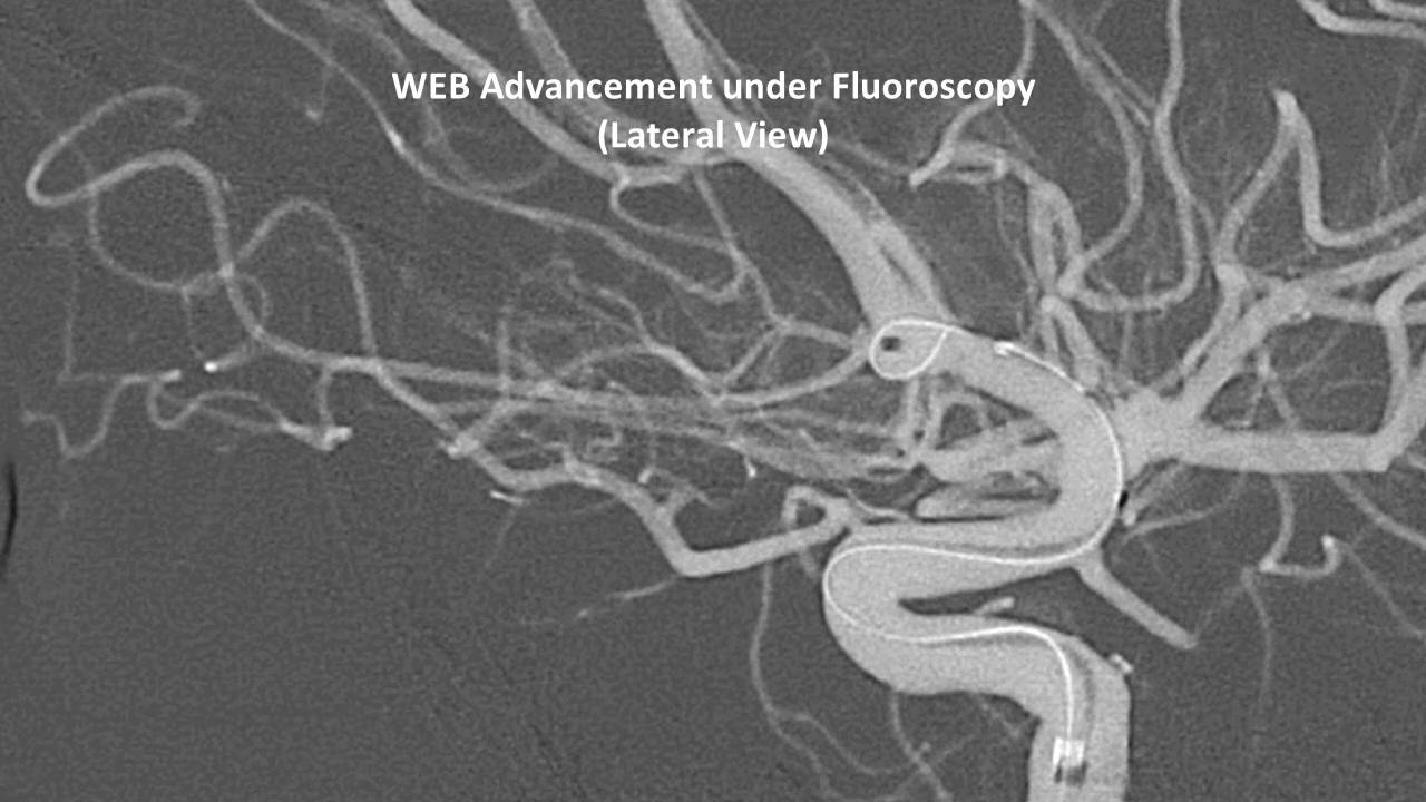 WEB Treatment of Ruptured 4 mm AcomA Aneurysm - YouTube