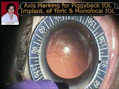 Piggyback Implantation of Toric and Multifocal IOL by Dr Suresh K ...