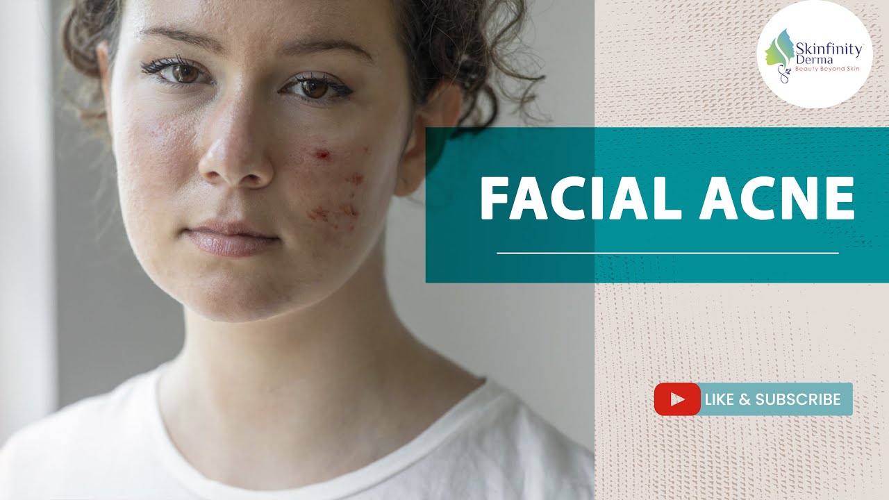 What are the different types of facial acne | How to Treat different ...