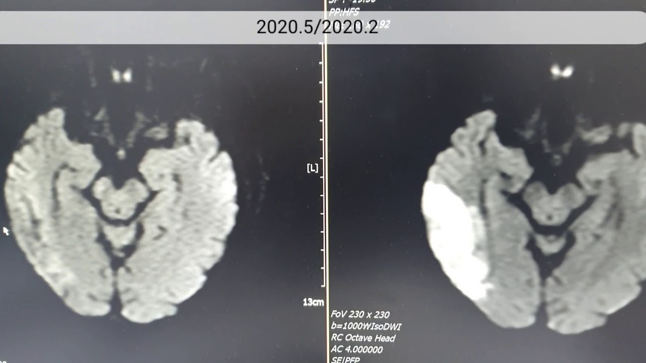 MRI DWI(diffusion) Comparative image - YouTube