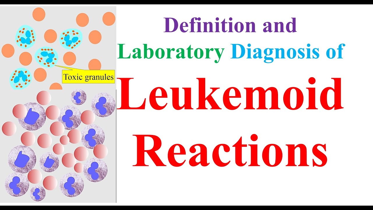 📌 Definition and Laboratory Diagnosis of Leukemoid Reactions | Causes ...