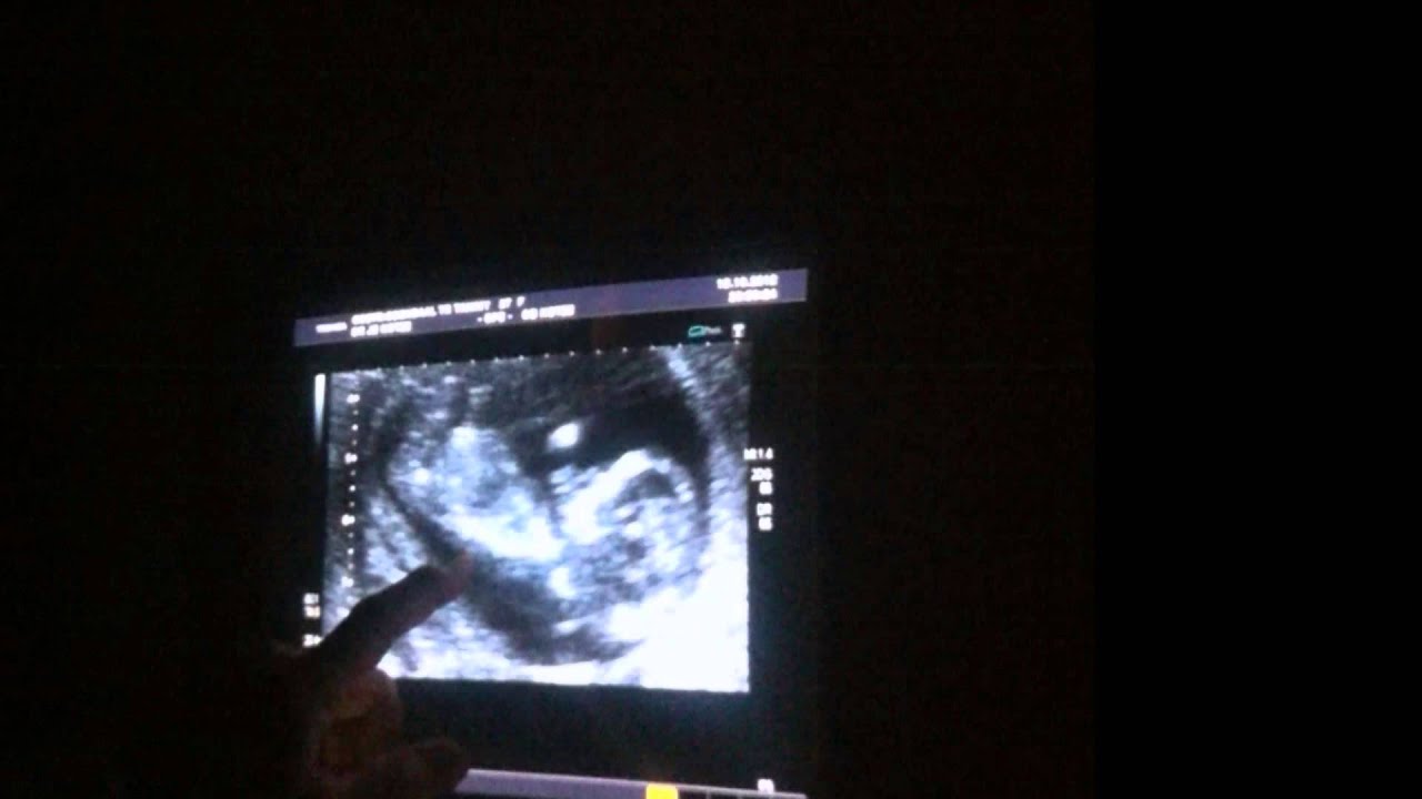Baby 0 3 month scan - YouTube