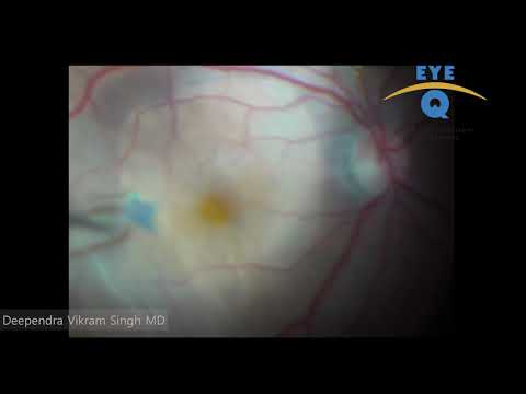 25G Vitrectomy thru Trifocal IOL - YouTube