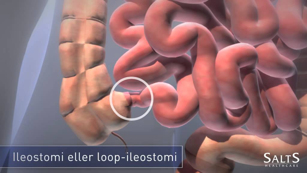 Ileostomi – inför operation - YouTube