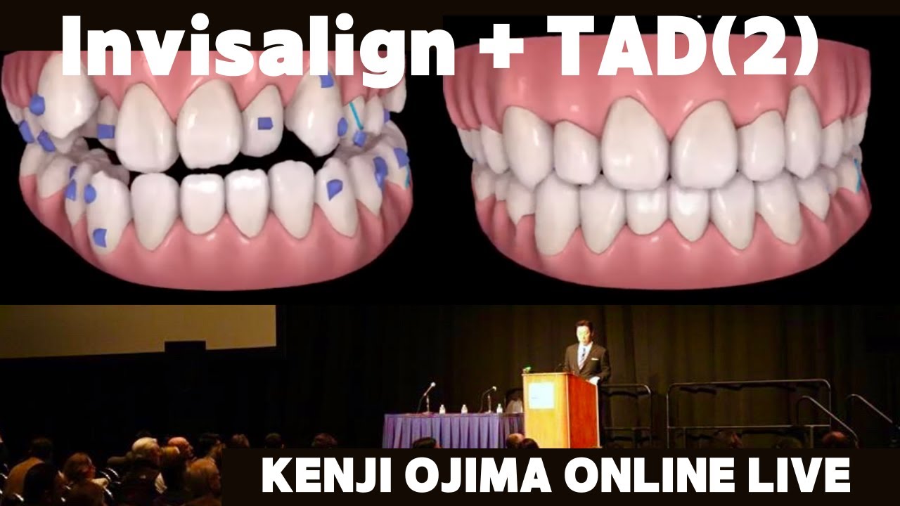 【Invisalign + TADs②】Kenji Ojima invisalign live - YouTube