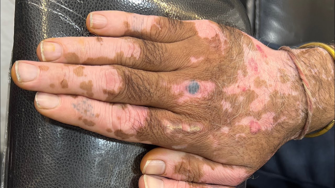 VITILIGO SKIN DISEASE TREASURE | FULL INFORMATION / SAFED DAAG KAISE ...