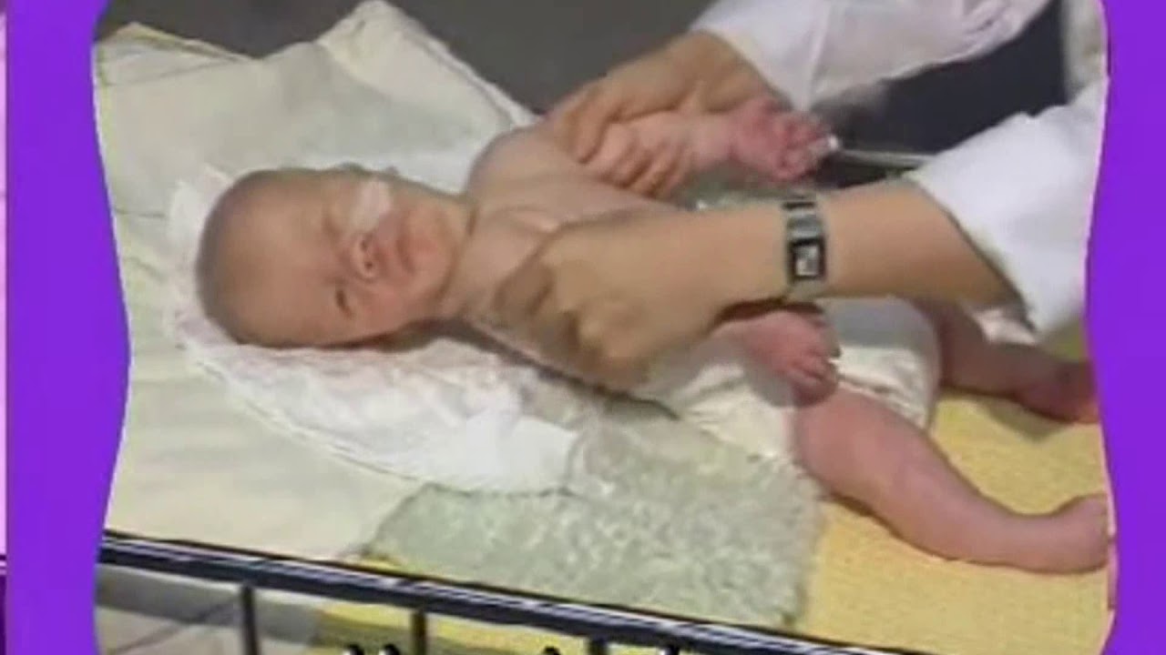 Exemplo de Hipotonia - YouTube