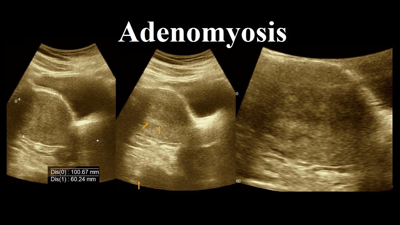 Adenomyosis || Adenomyosis ultrasound findings || Amader hospital ...
