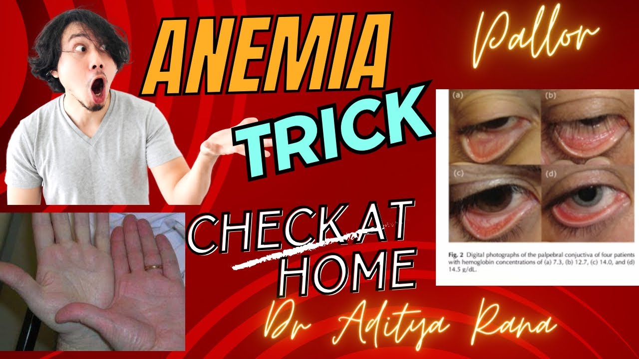How to Check Anemia / Pallor / At home 🏡 Easy trick😁 - YouTube