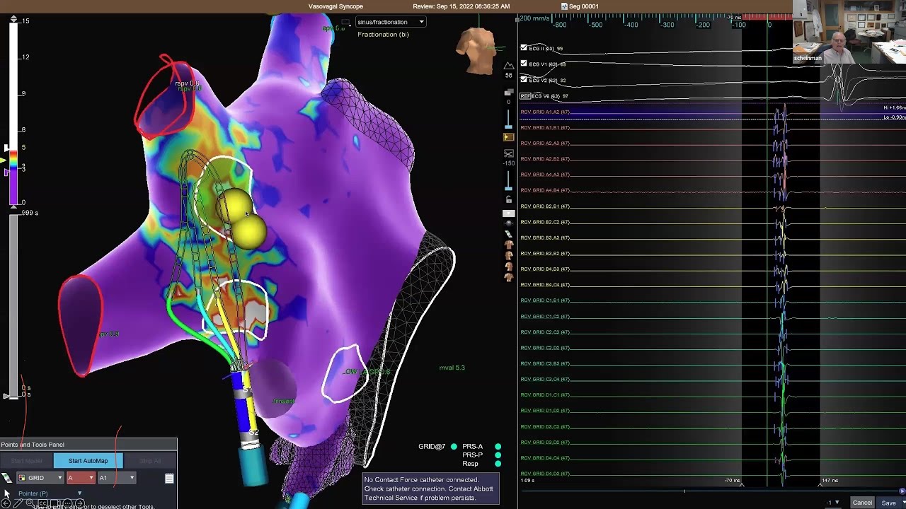 Approach to the Diagnoses & Treatment of AV Block - YouTube