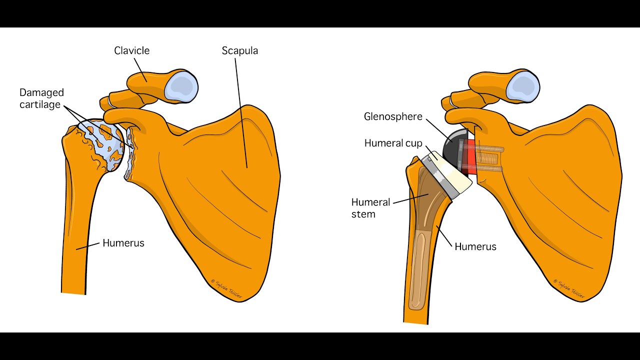 BIO RSA - Shoulder Arthroplasty - YouTube