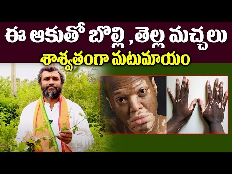 Ee ఒక్క ఆకుతో శరీరం పై ఎక్కడ బొల్లి మచ్చలు ఉన్న శాశ్వతంగా మాయం | bolli machalu tips in telugu