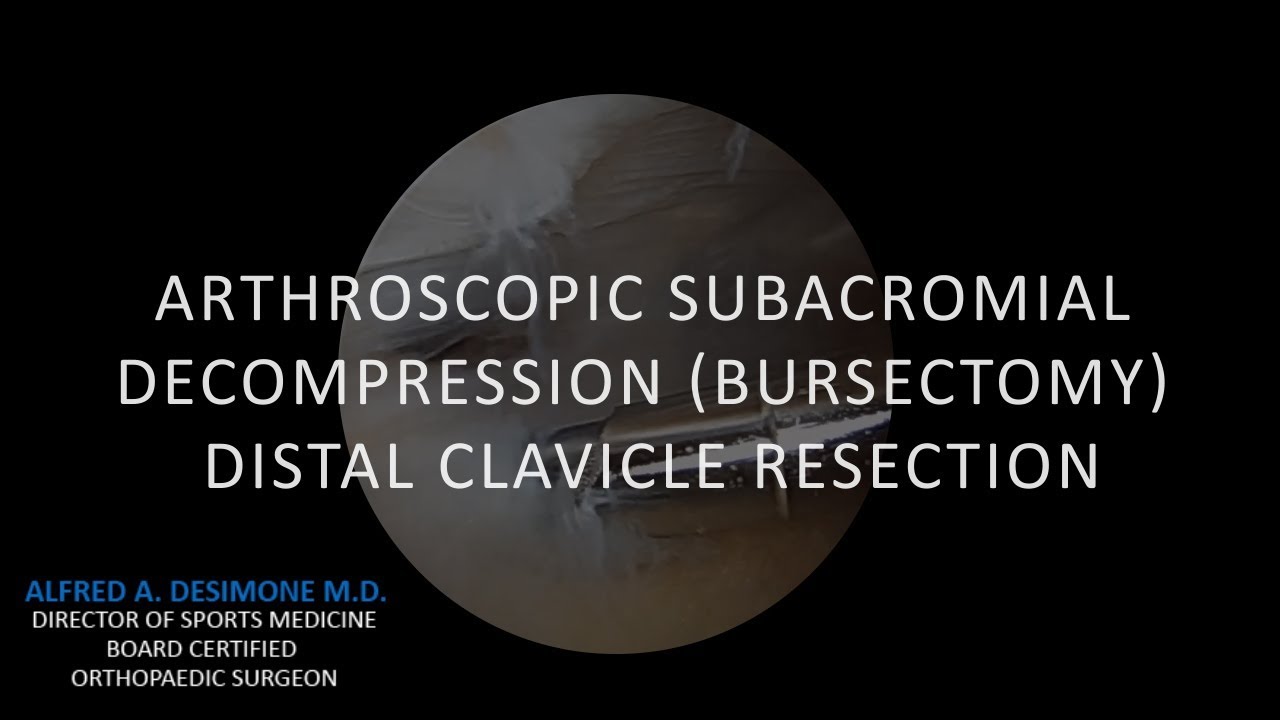 Arthroscopic Subacromial Decompression Bursectomy Distal Clavicle ...