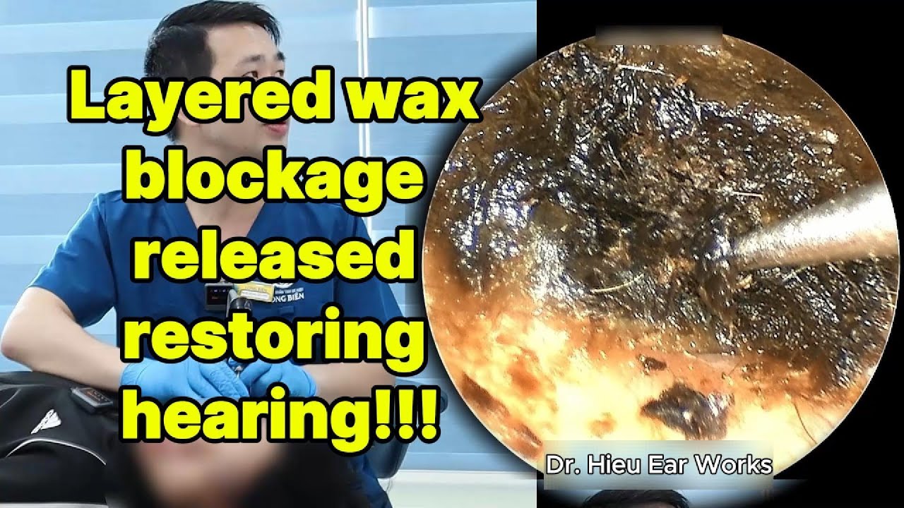 Layered wax blockage released restoring hearing | ear cleaning | ASMR ...