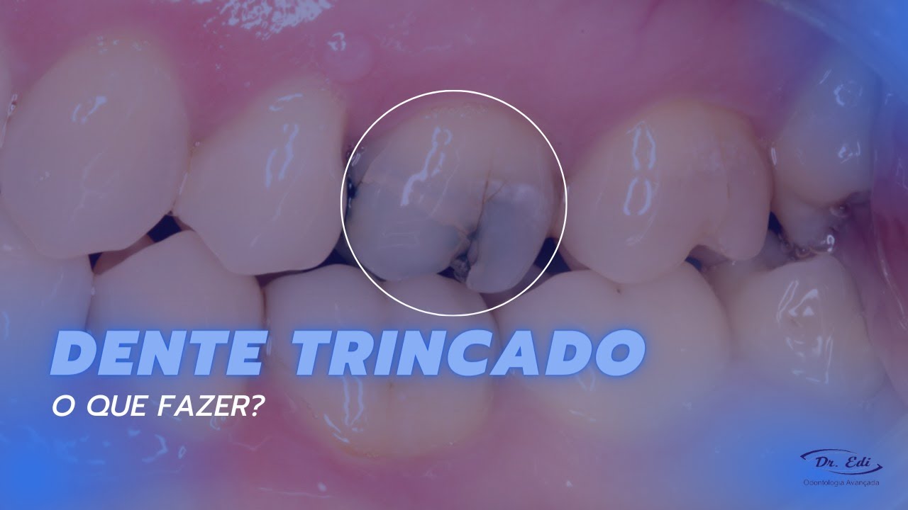 Dente trincado, o que fazer? veja as causas e tratamentos! - YouTube