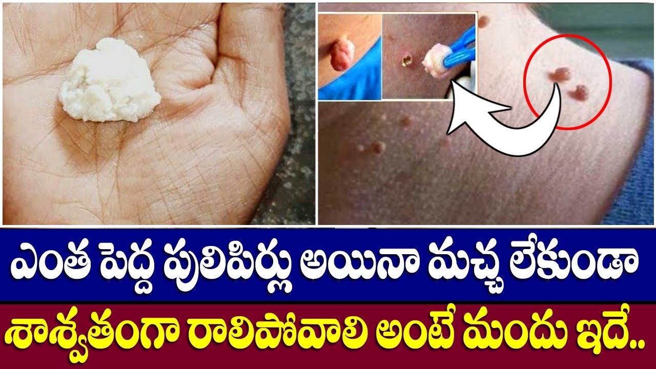పులిపిర్లు | Pulipirlu Treatment In Telugu | How To Remove Warts | How ...