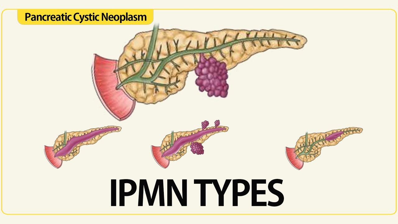 Linear EUS: IPMN TYPES - YouTube