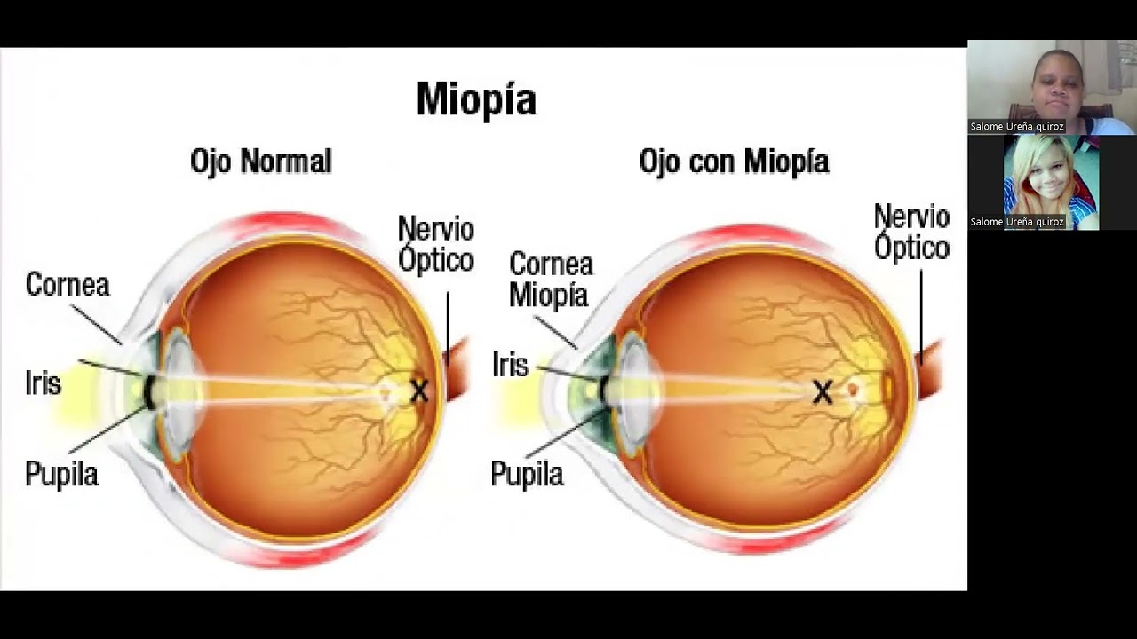 LA MIOPIA - YouTube