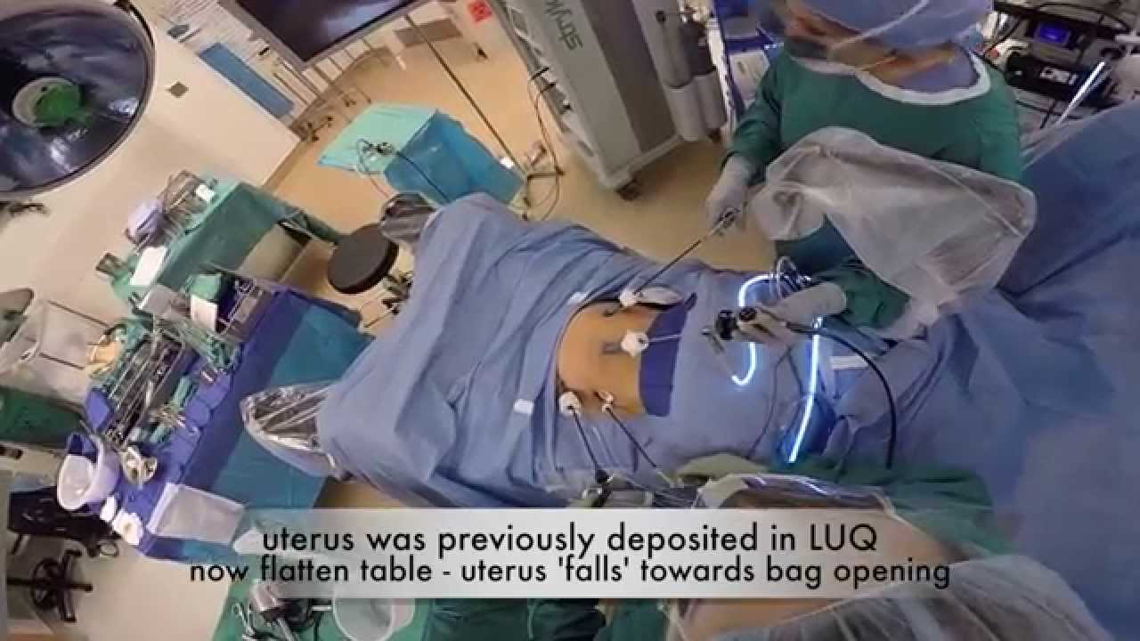 Safe contained morcellation in an isolation insufflated bag - YouTube