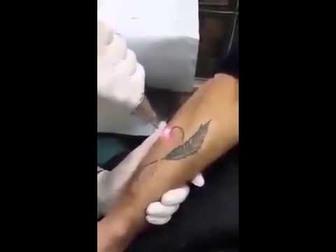 Dövme Nasıl Silinir Tattoo