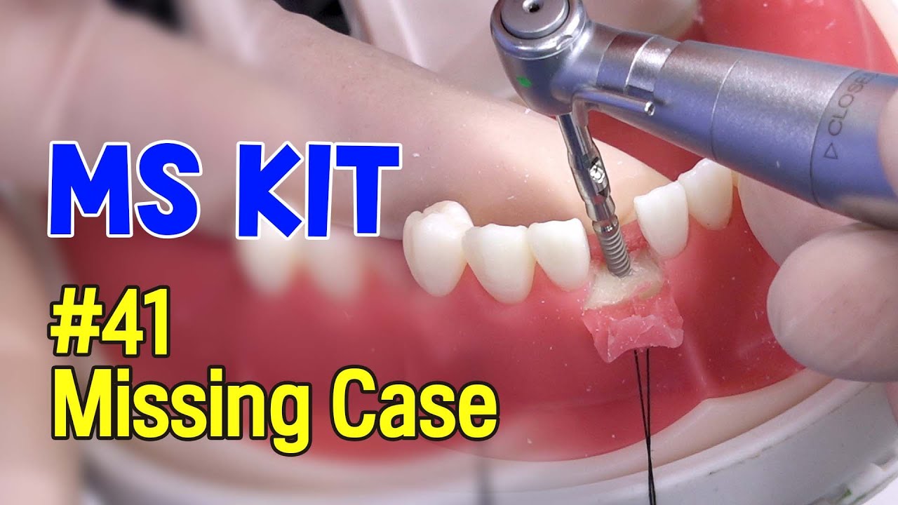 [EASY Hands-on] MS KIT - #41 Missing Case - YouTube