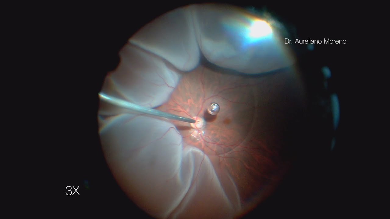 Superior Retinal Detachment that is not involving the Macula ...