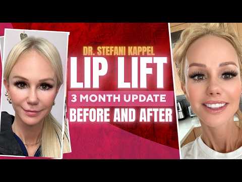 My Lip Lift Before and After: 3 Month Update + What I Learned
