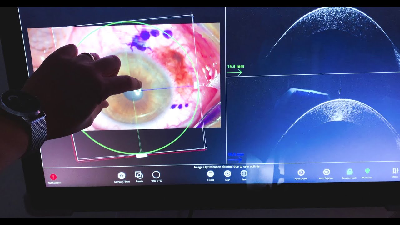 Why intraoperative OCT visualization has great advantages for pediatric ...