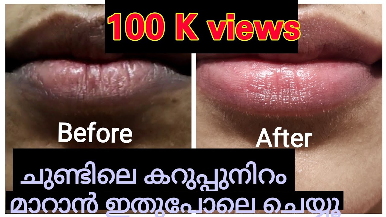 Dark Lips Treatment👄How to get rid of dark lips#Pigmented lip care# how ...
