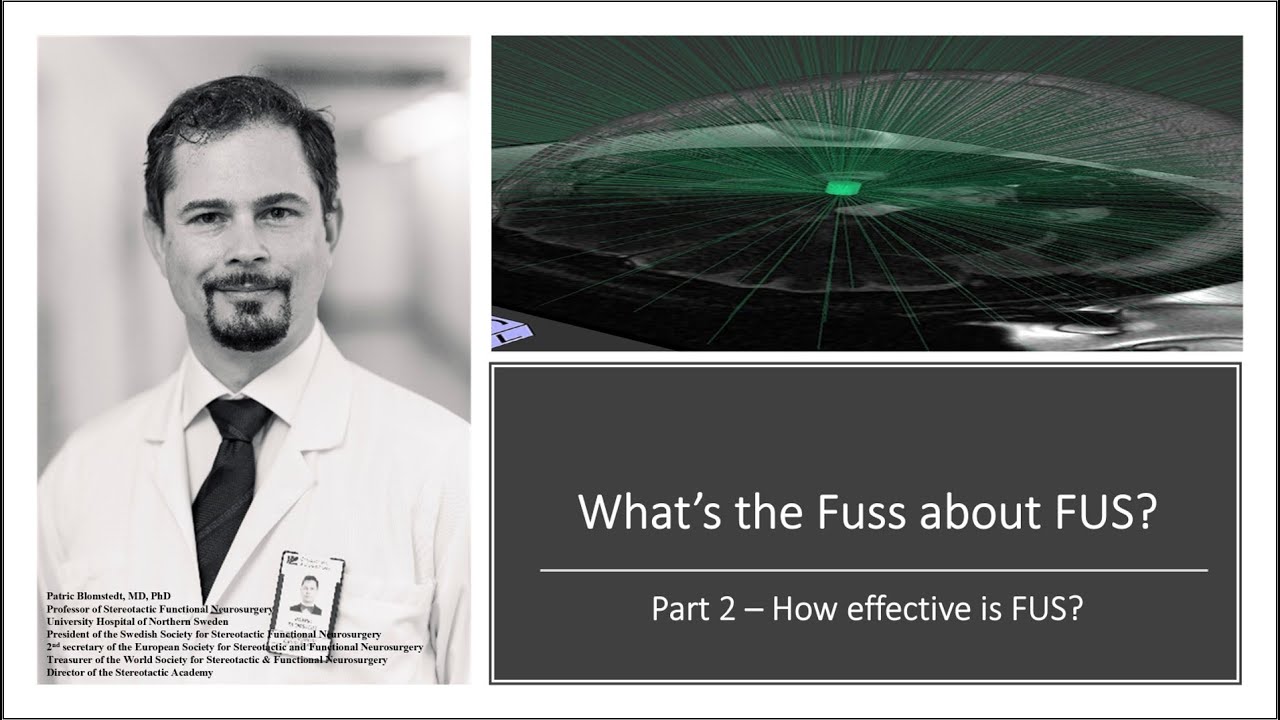 What's the fuss about FUS - Part 2: How effective is FUS? - YouTube