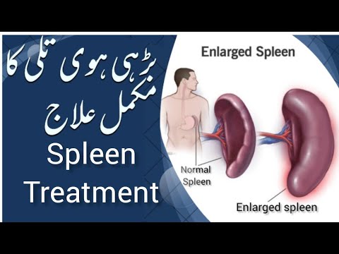 Best treatment of enlarged spleen | diagnosed nafees clinic - YouTube