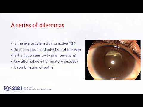 Diagnosis of Ocular Tuberculosis Dr Samir Shawki head of Egyptian Uveitis Study Group