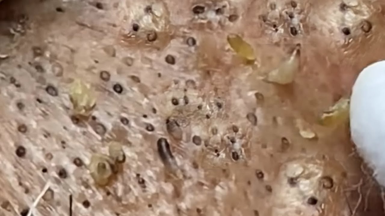 Satisfying Acne and Pimple Removal Blackheads & Whiteheads #1183 - YouTube