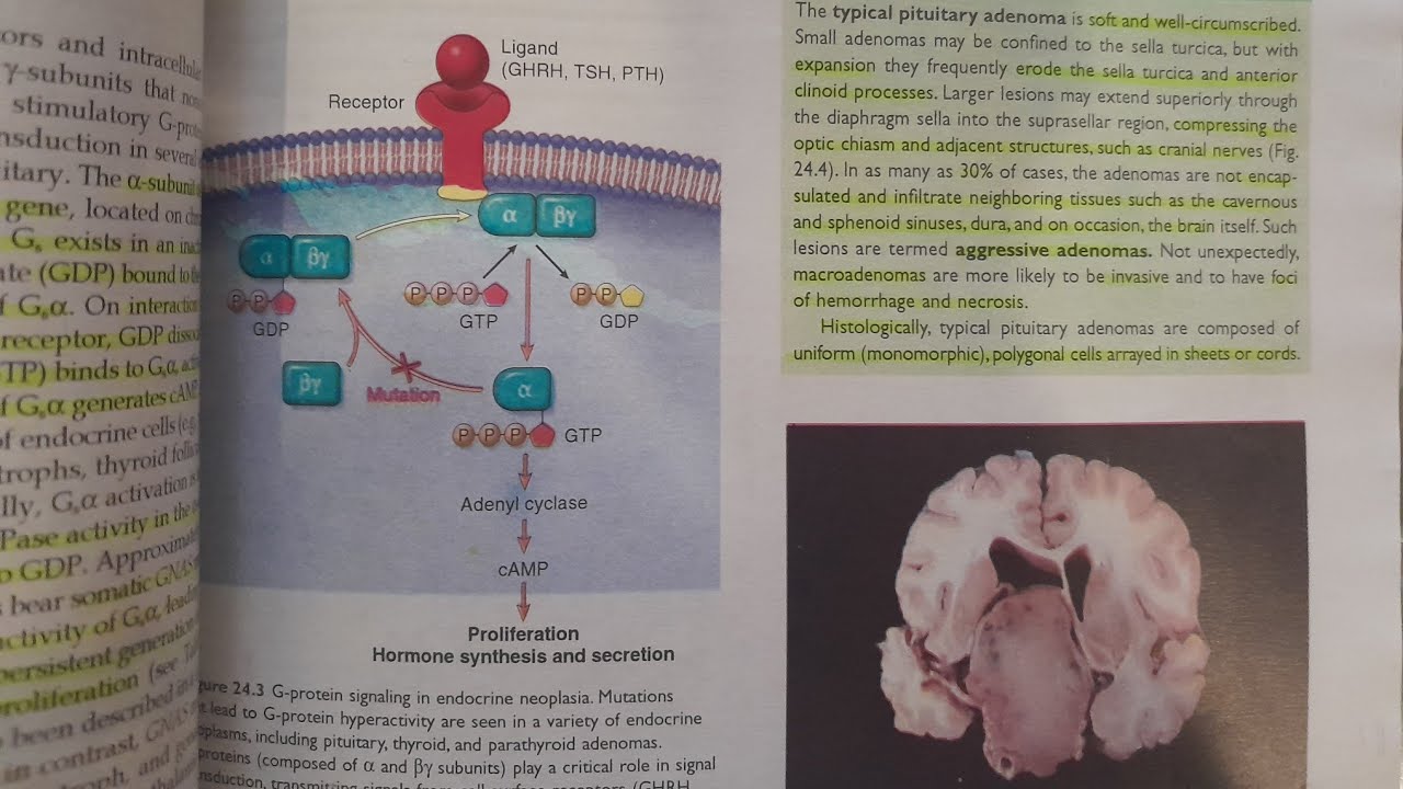 Pituitary Adenoma and Hyperpituitarism Part 1 - SPECIAL PATHOLOGY - YouTube