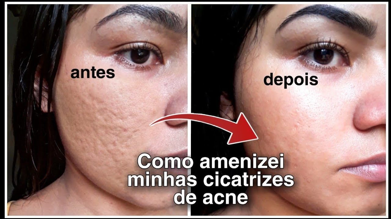 COMO ACABAR COM CICATRIZES DE ACNE NATURALMENTE, tratamento caseiro pra ...