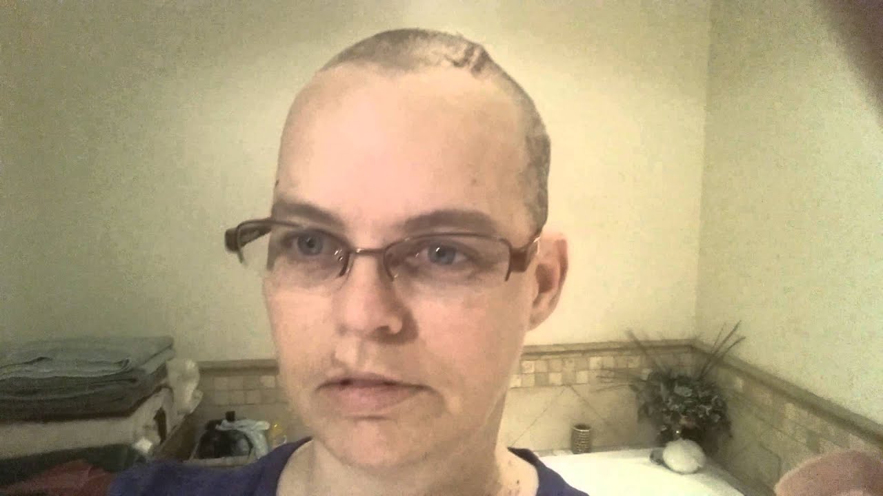 Essential tremor, recovering from #DBS surgery - YouTube