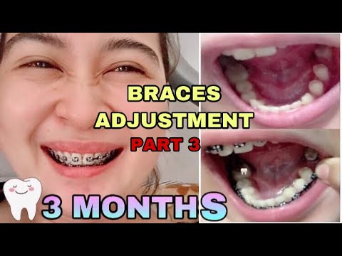 BRACES ADJUSTMENT (MIDLINE TEETH ALIGNMENT) PHILIPPINES - YouTube